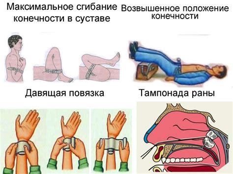 Кровотечение. Методы остановки кровотечений - online presentation