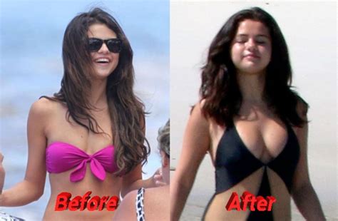 Selena Gomez Before And After Breast Implants
