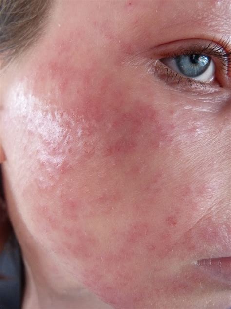 I Have Eczema: April 2013