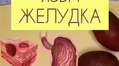 Средство от язвы желудка 🤔