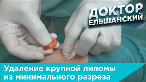 Удаление крупной липомы из минимального разреза - YouTube