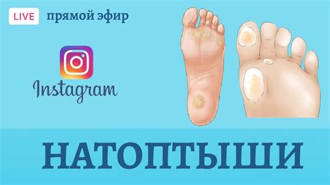Натоптыши и лечение - YouTube