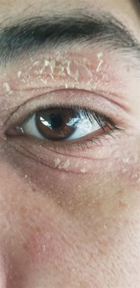 Eczema around my eye. : r/peeling