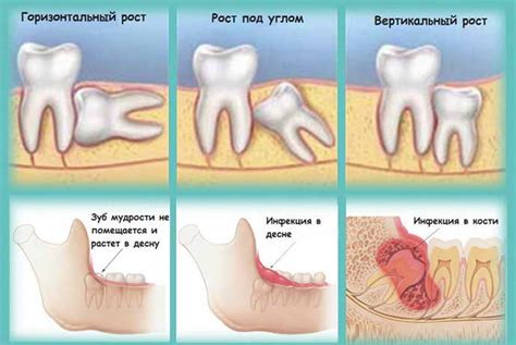 Удаление зуба мудрости по низкой цене | НоваДент