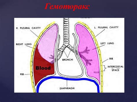 Хирургическая тактика при гемотораксе - презентация онлайн