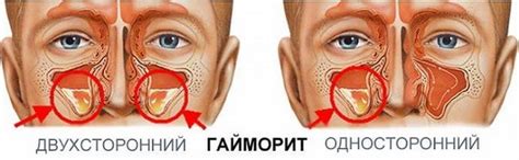 Гнойный гайморит: симптомы, лечение у взрослых и детей