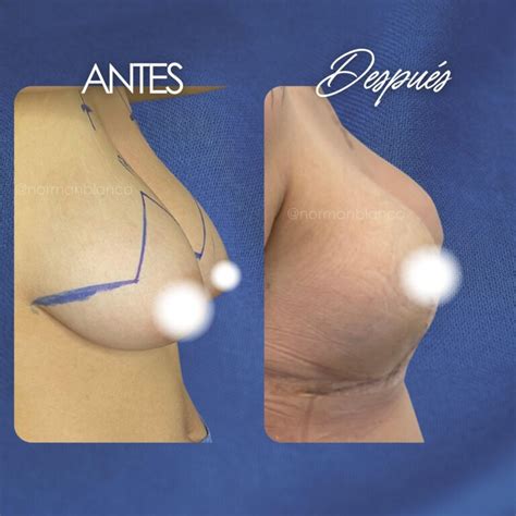 Procedimientos Mamarios - MAMOPLASTIA DE REDUCCIÓN - dr-normanblanco.com