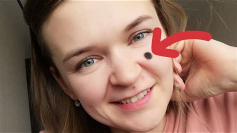 Как я УДАЛИЛА все родинки на лице за 4 года | МОЯ ИСТОРИЯ УДАЛЕНИЯ ...