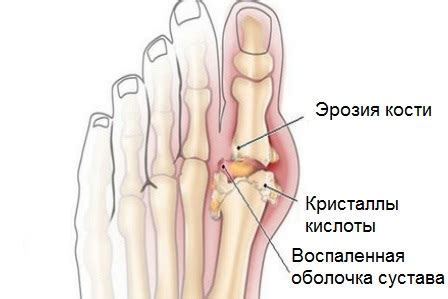 Аллопуринол при подагре: как принимать, дозировка, цена, отзывы