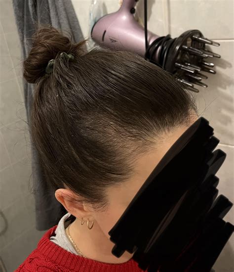 Progress !! with Minox 5% solution : r/FemaleHairLoss