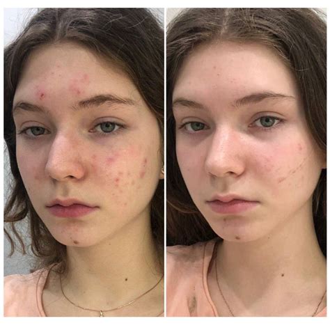 Teenagers and Skinjestique: Peptides Explained – Skinjestique Global