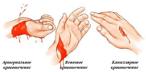 Первая помощь при кровотечении