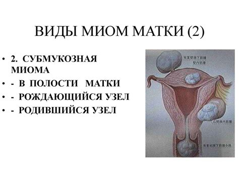 Миома матки - online presentation