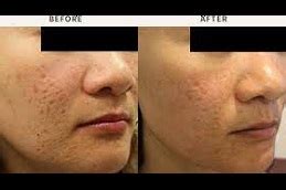 Best Evo Laser in Dubai, Abu Dhabi & Sharjah | Royal Clinic