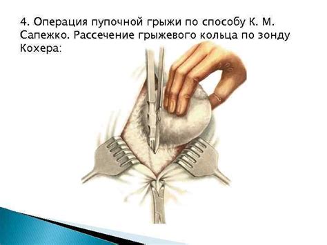 Пупочные и внутренние грыжи Натопкин Я Ю Гр