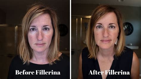Fillerina Plumping System Review - BEFORE and AFTER - YouTube