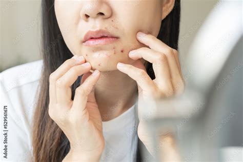 Expression worry asian young woman hand touching pustule around the chin and mouth, allergic ...