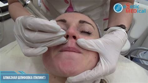 Алмазная шлифовка микродермабразия пилинг в Одессе клиники Estetic ...