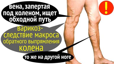 Варикоза не будет. Прекратите сопротивляться венозному оттоку 👍 - YouTube