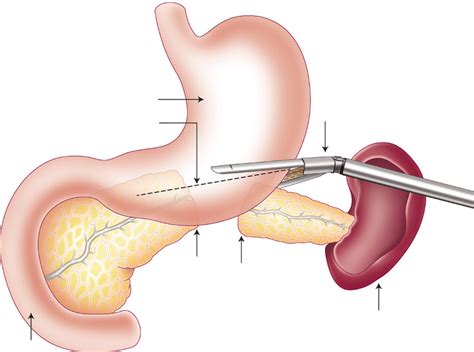 Schematic drawing showing the first part of the laparoscopic long... | Download Scientific Diagram