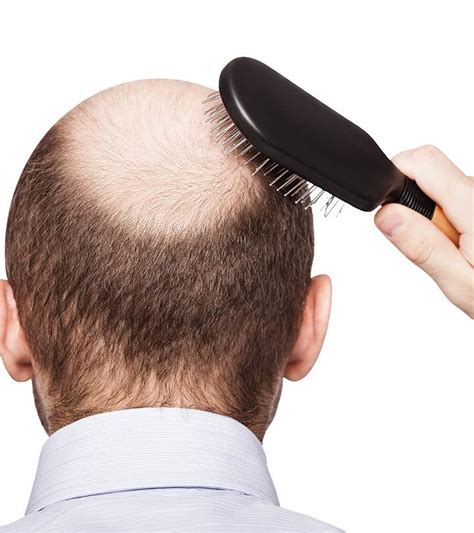 How to reduce dht hair loss what are the treatment options – Artofit