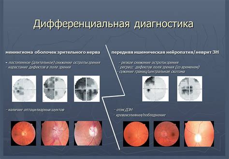 Методы лечения частичной и полной атрофии зрительного нерва за рубежом ...
