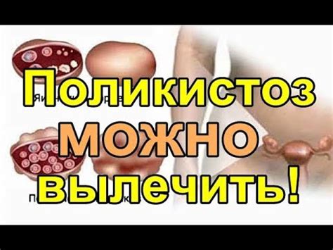лечение поликистоза яичников. Поликистоз можно вылечить! - YouTube