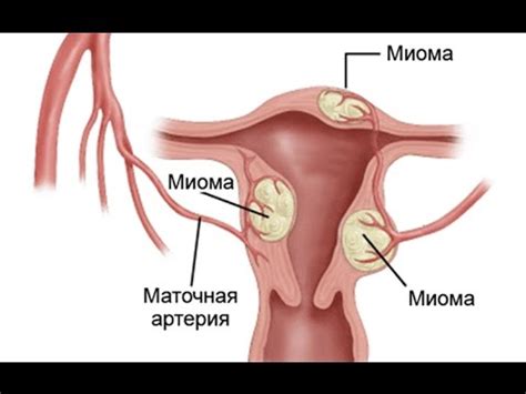 Миома матки лечение без операции. Лечение миомы матки. - YouTube