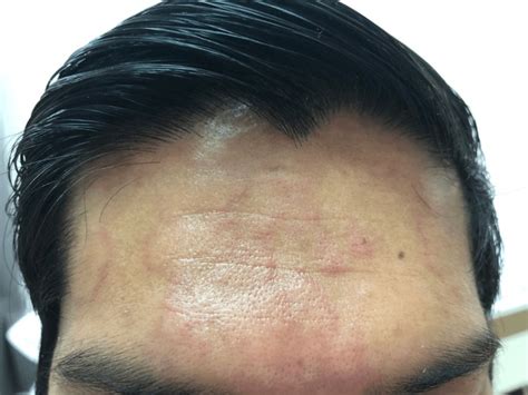 1 Annular Urticaria Images, Stock Photos, 3D objects, & Vectors ...