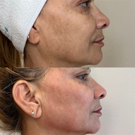 Deka Laser Patient 2 - Florida Lakes Spa