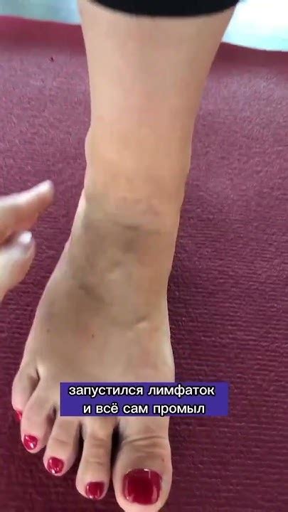 Избавиться от отека - YouTube