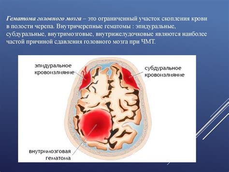Гематомы головного мозга - презентация онлайн