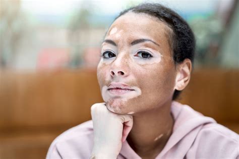 Upadacitinib Meets Primary End Point of Phase 2 Trial for Vitiligo and Advances to Phase 3