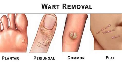 3 Common Misconceptions Regarding Wart Removal – The Silver Bird