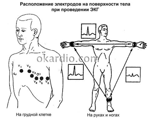 ЭКГ при инфаркте миокарда: диагностические признаки, определение ...