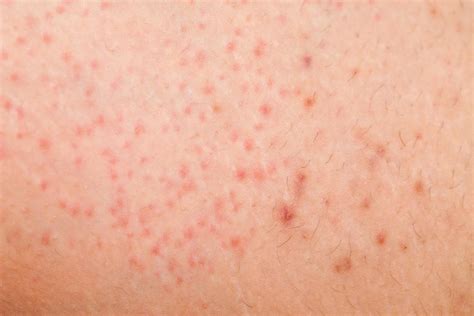 Itchy after shaving: Why it happens and how to stop it