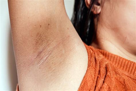 How to Treat an Armpit Rash and When to See a Dermatologist | Cascade Eye & Skin Centers