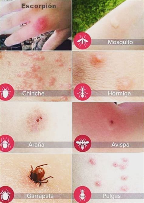 Tipos De Picaduras De Insectos