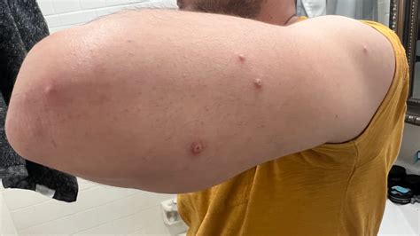 What Does Monkeypox Look Like? Here’s What Health Experts Say – NBC Chicago