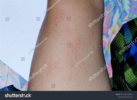 2 Urticarial Rash Feet Images, Stock Photos, 3D objects, & Vectors | Shutterstock