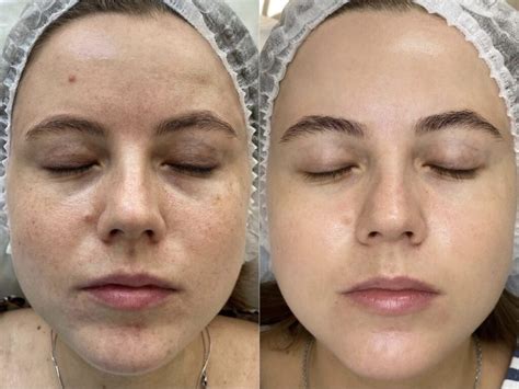 PRX-T33 Peel Treatment In London - Reveal Clearer Skin