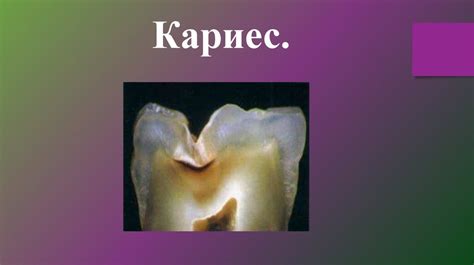 Кариес зубов - презентация онлайн