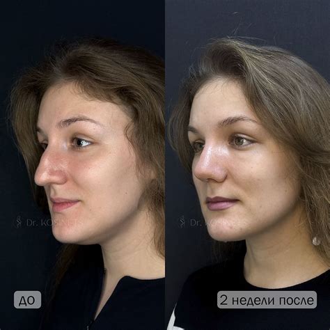 Ринопластика носа - Цена в Москве | Пластика носа | Сколько стоит ...