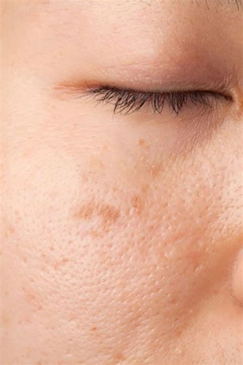 Sun Damage - Effect of Sun Exposure | Skin Associates of South Florida