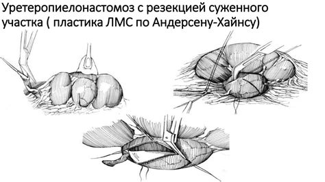 Обструктивная уропатия - презентация онлайн