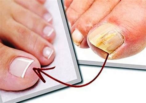 Как лечить грибок на ногтях ног в домашних условиях — Своими руками… Да!