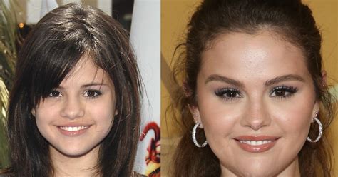 Selena Gomez Plastic Surgery Before And After Lips
