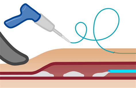 Benefits of Venaseal - Delaware Vein Center