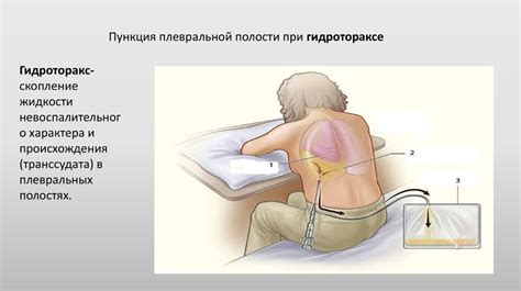 Пневмоторакс, гидроторакс - презентация онлайн
