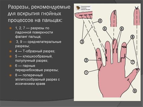 Гнойная хирургия конечностей - презентация онлайн